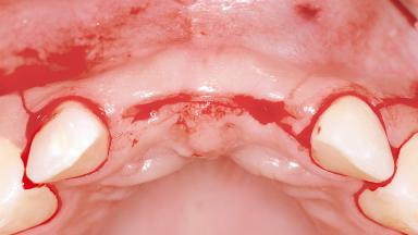 Replacement of Two Central Incisors with Non-Splinted Crowns on Bone ...