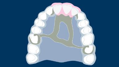 Transitional Prostheses Used During Implant Therapy - Learning Modules ...
