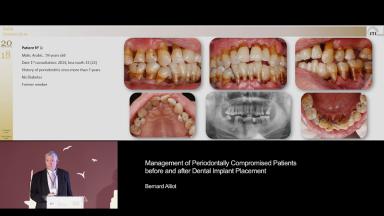 Management of Periodontally Compromised Patients before and after ...