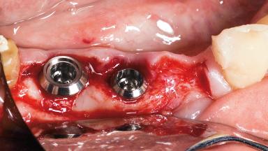 Replacement of Multiple Teeth in a Partially Dentate Posterior Mandible ...